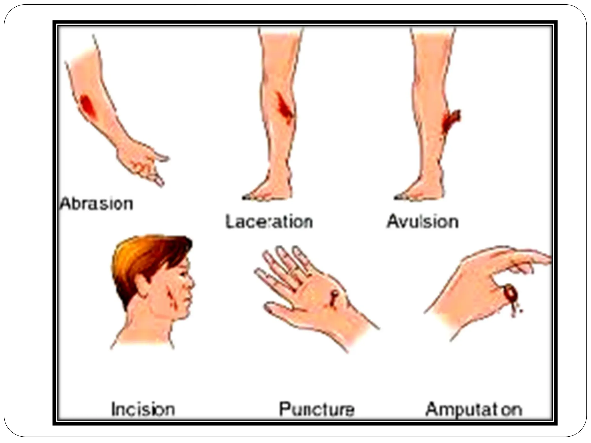 213095393-Types-of-Wounds for orthopedicand TraumaMedicinestudents.ppt