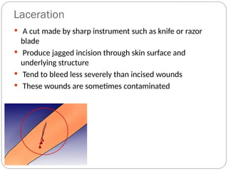 213095393-Types-of-Wounds for orthopedicand TraumaMedicinestudents.ppt