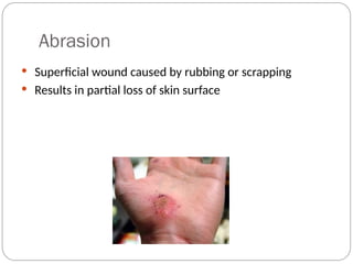 213095393-Types-of-Wounds for orthopedicand TraumaMedicinestudents.ppt
