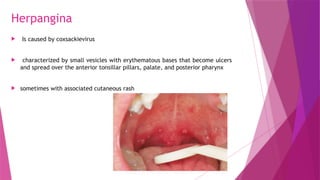 pharyngotonsillitis causes and diffrent treatment.pptx