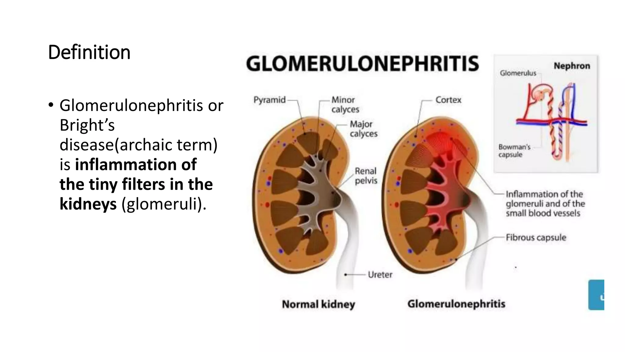 2_18. Glomerulonephritis.pptx