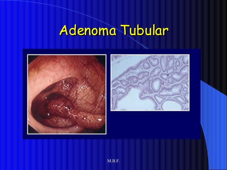 21 CáNcer Colon Mbf