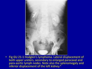 21 deviation of the ureter | PPT