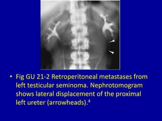 21 deviation of the ureter | PPTX
