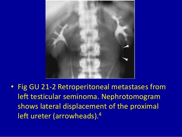 21 deviation of the ureter