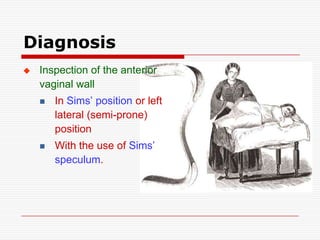 genito urinary fistula | PPTX