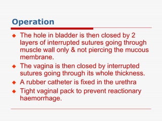 genito urinary fistula | PPTX