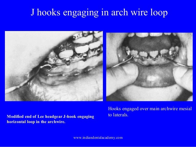 J hook head gear /certified fixed orthodontic courses /certified…