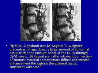 21 postoperative lumbar region of spine on magnetic | PPTX