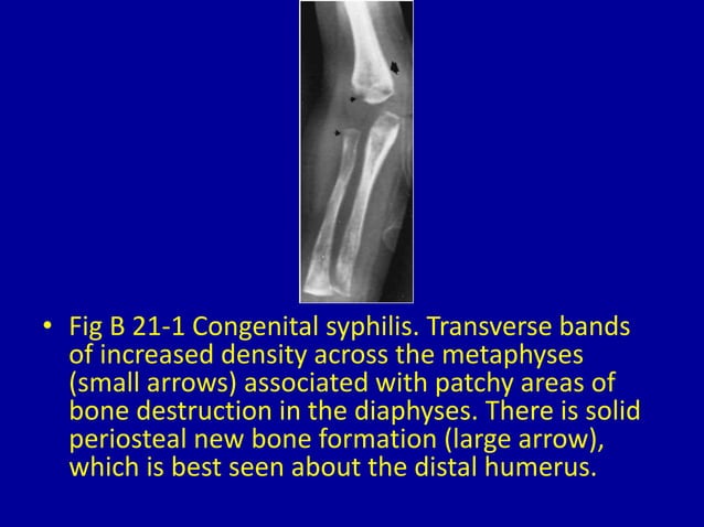 21 radiolucent metaphyseal bands | PPTX | Bone and Joint Conditions | Diseases and Conditions