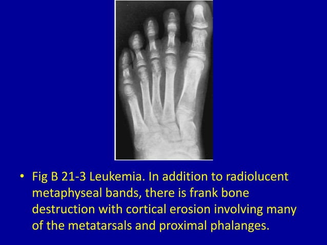 21 radiolucent metaphyseal bands | PPTX | Bone and Joint Conditions | Diseases and Conditions