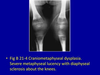 21 radiolucent metaphyseal bands | PPTX