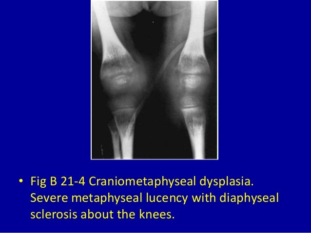21 radiolucent metaphyseal bands