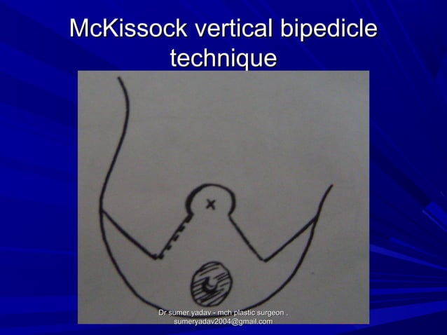 reduction mammoplasty | PPT