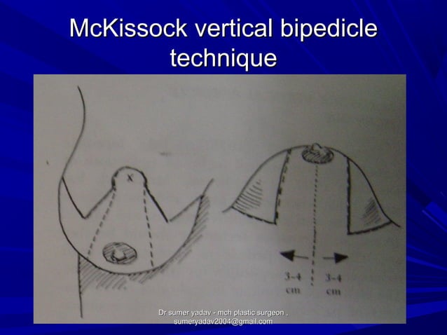 reduction mammoplasty | PPT