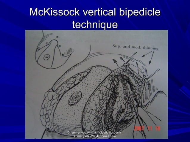 reduction mammoplasty | PPT