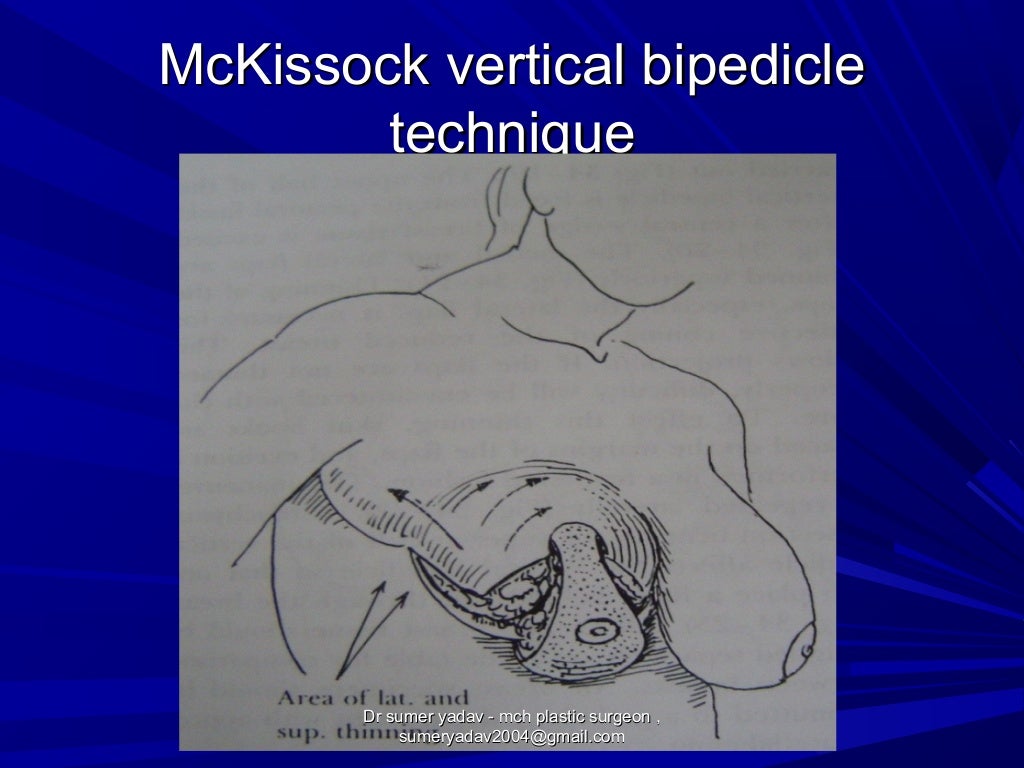 Reduction Mammoplasty