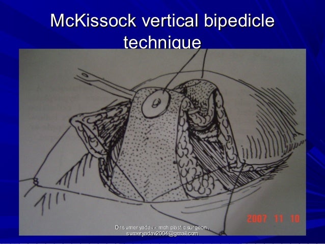 reduction mammoplasty