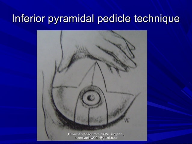 reduction mammoplasty
