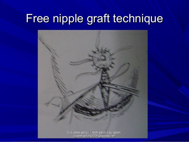 reduction mammoplasty