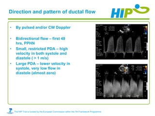 Ductus Arteriosus | PDF