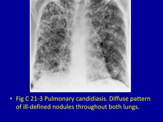 21 skin disorder combined with widespread lung disease | PPTX