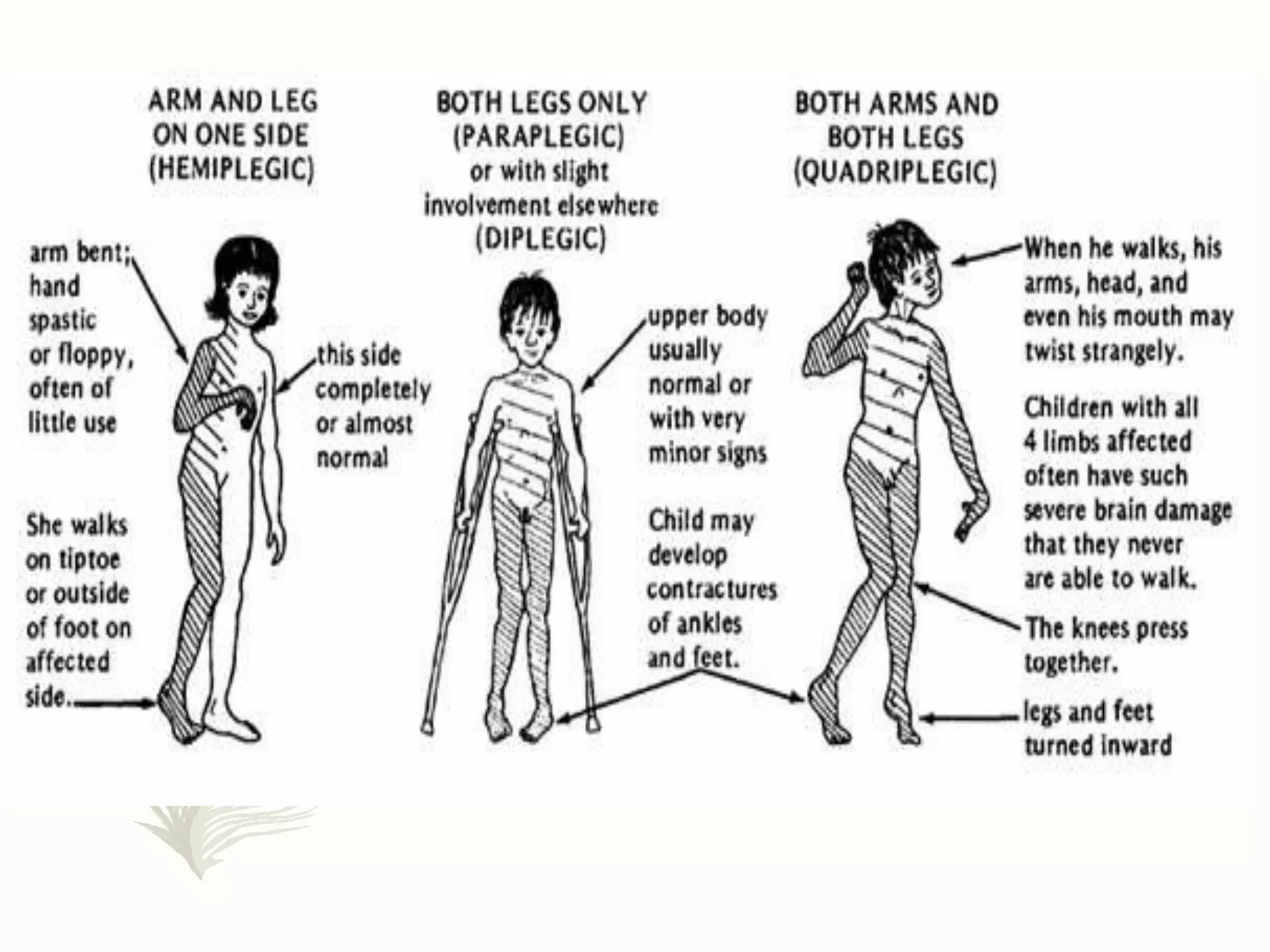 Cerebral Palsy in Children | PPTX