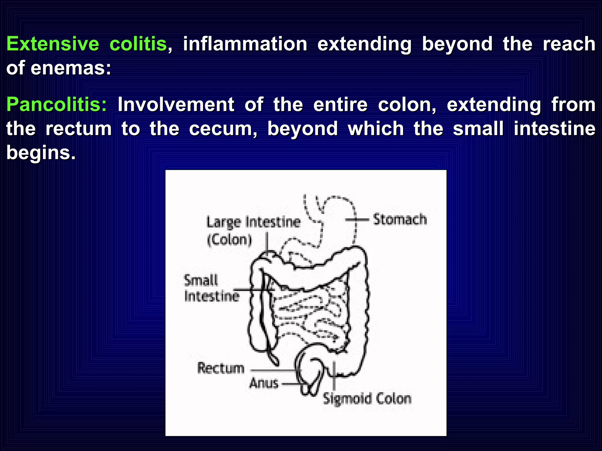 21 ulcerative colitis | PPT