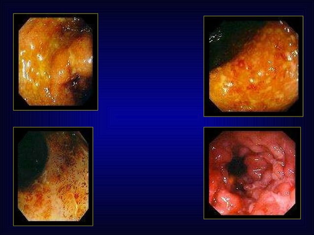 21 ulcerative colitis | PPT