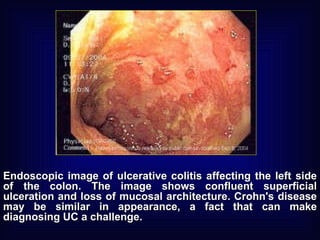21 ulcerative colitis | PPT