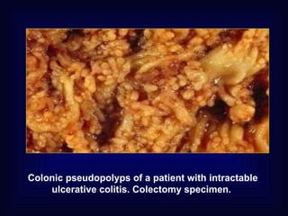 21 ulcerative colitis | PPT
