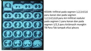 22-01-2022 TUBERKULOMA.pptx