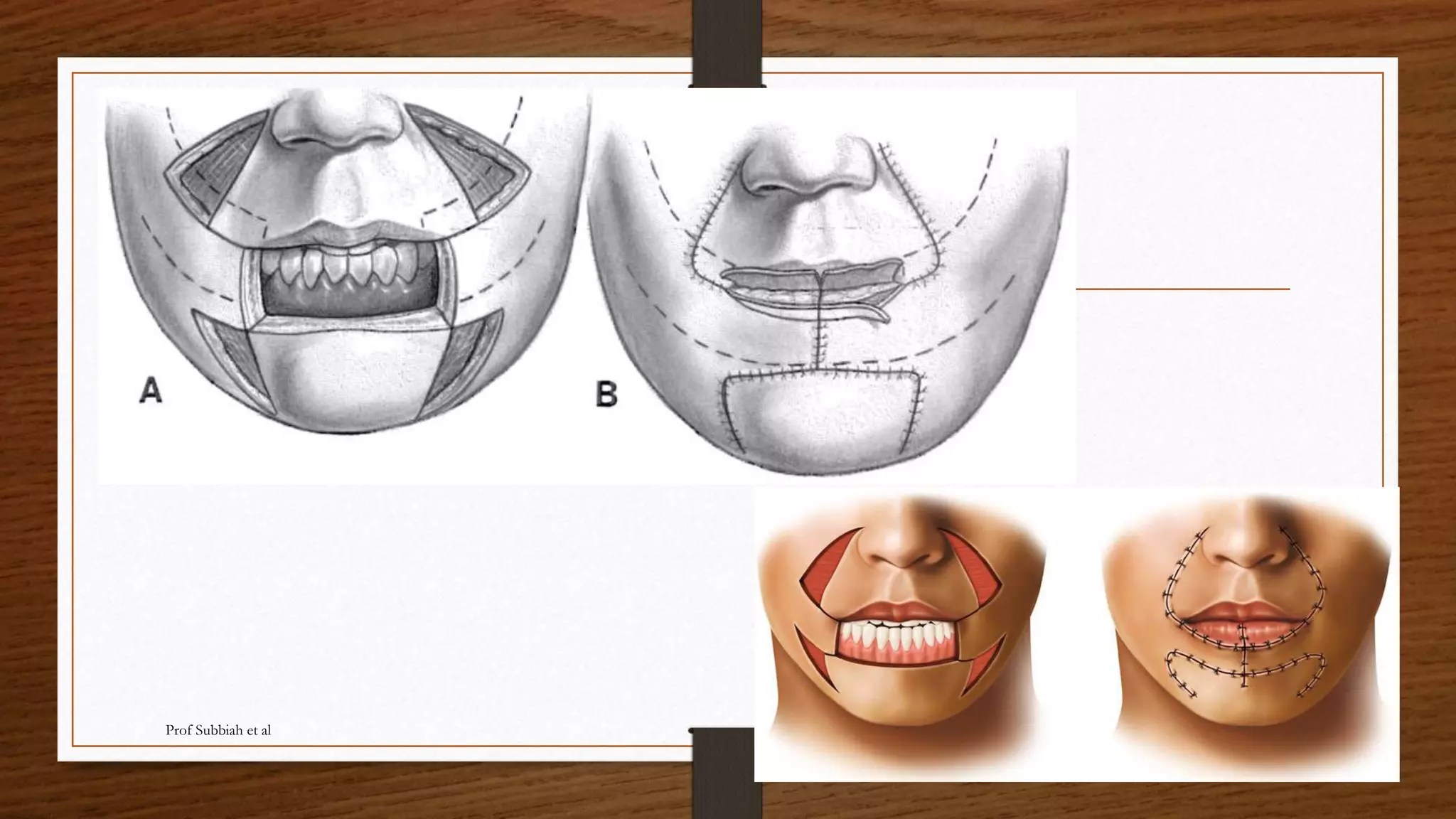 LIP RECONSTRUCTION ppt.pptx