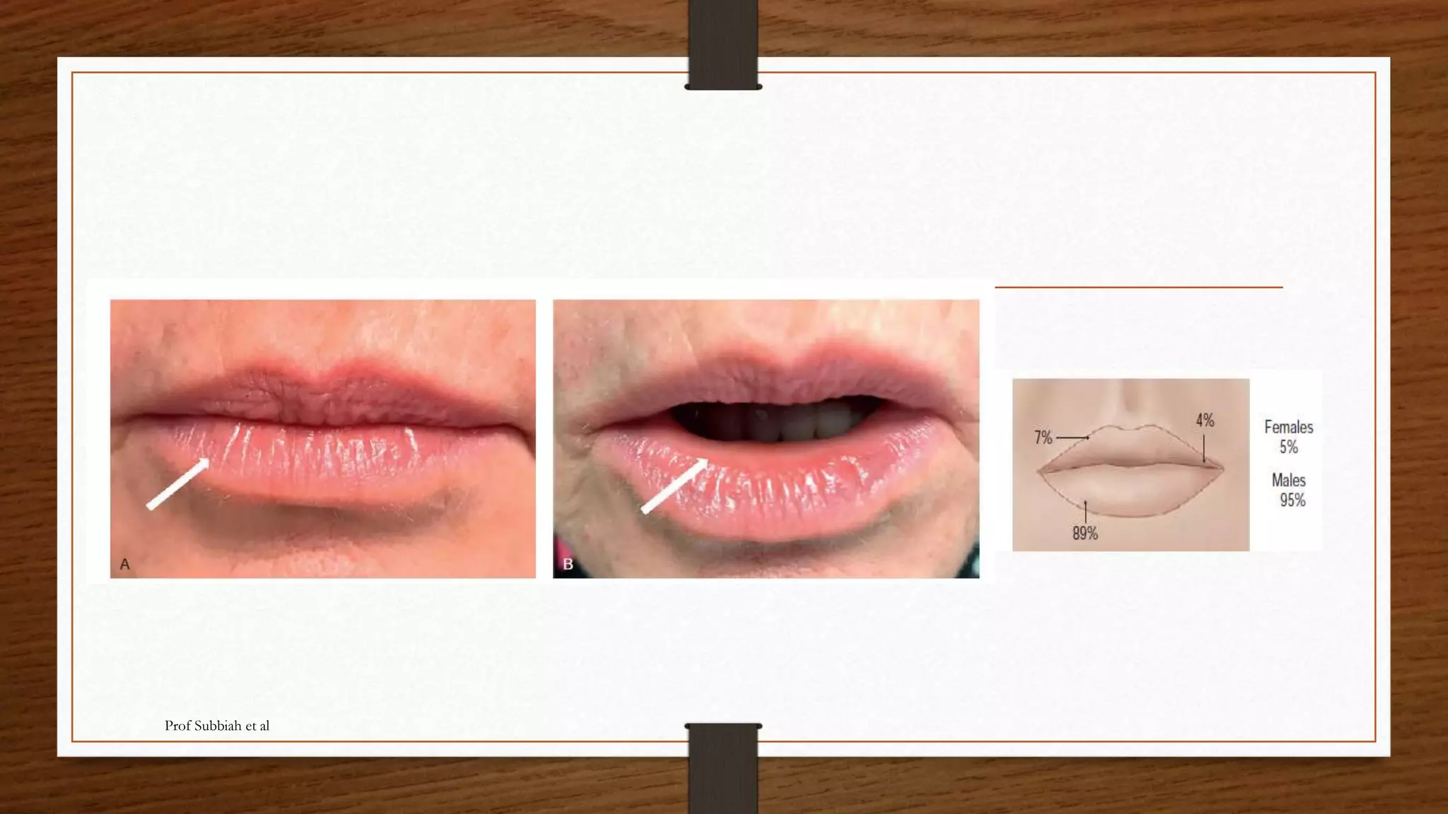 LIP RECONSTRUCTION ppt.pptx