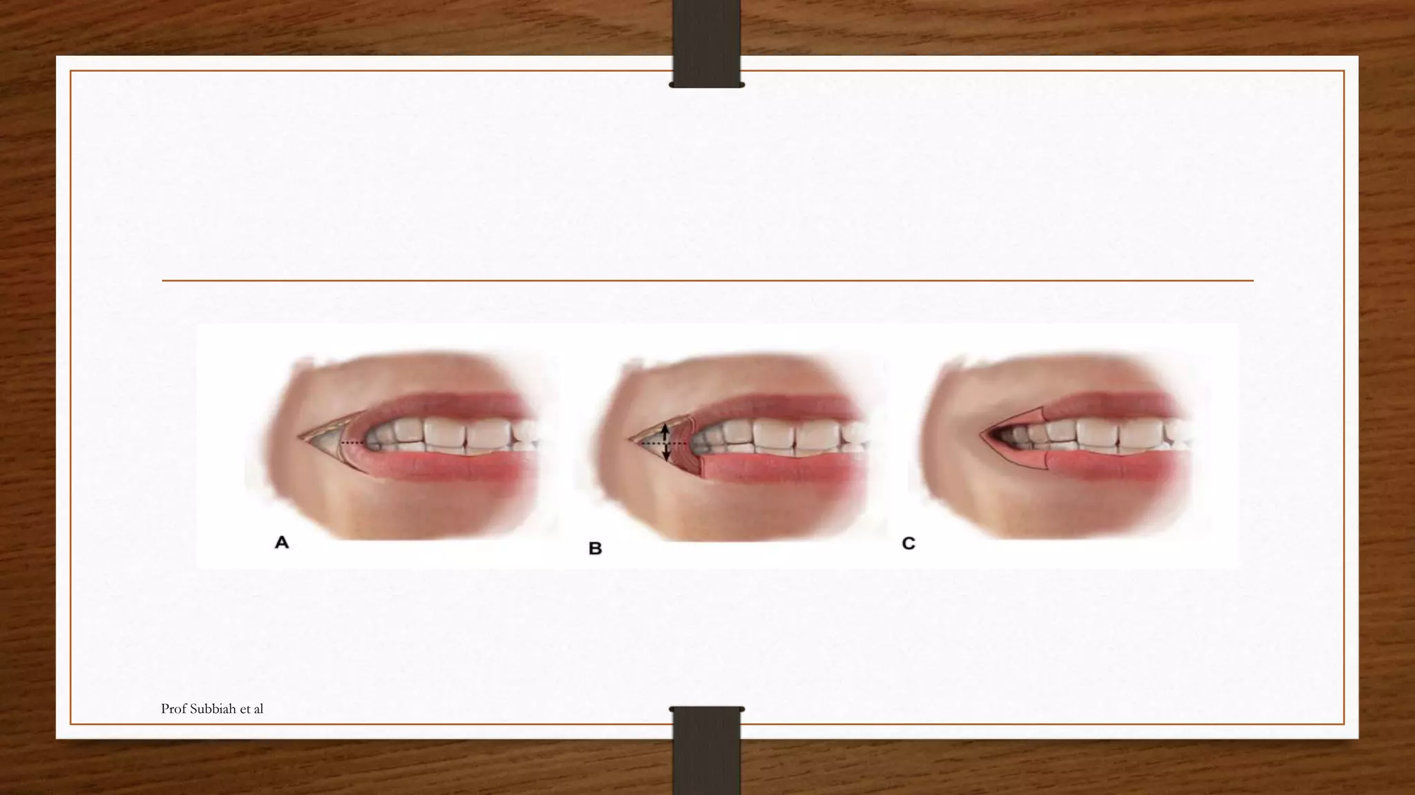 LIP RECONSTRUCTION ppt.pptx | Ear, Nose and Throat Conditions ...