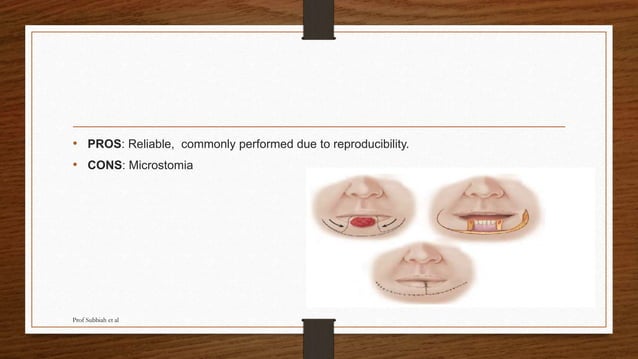 LIP RECONSTRUCTION ppt.pptx | Ear, Nose and Throat Conditions ...