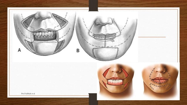 LIP RECONSTRUCTION ppt.pptx | Ear, Nose and Throat Conditions ...