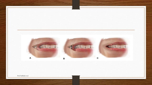 LIP RECONSTRUCTION ppt.pptx | Ear, Nose and Throat Conditions ...