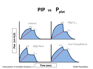 22 09-12 how do i ventilate normal lung | PPT