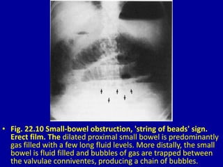 22 DAVID SUTTON PICTURES THE ACUTE ABDOMEN | PPTX