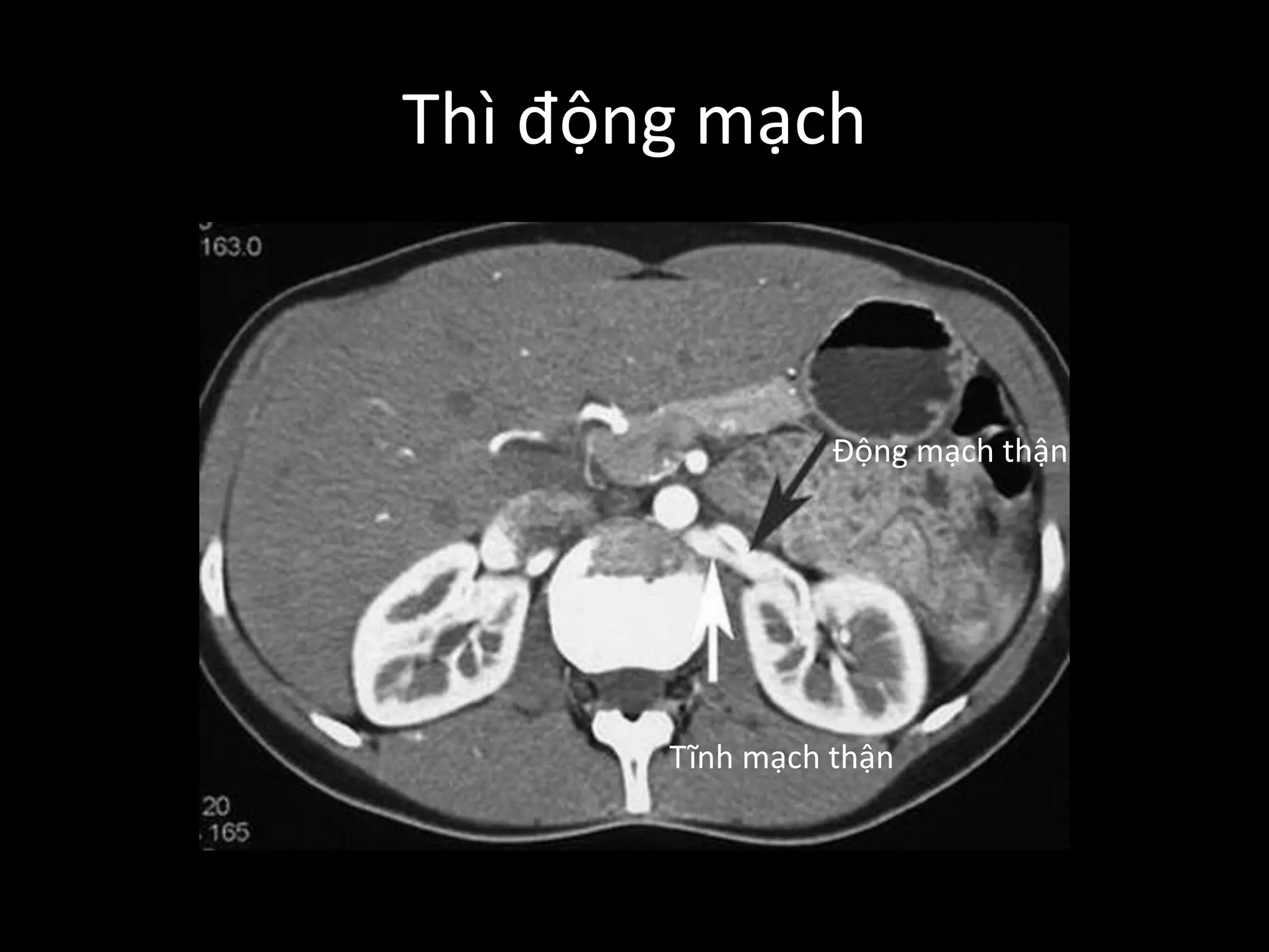CLVT hệ tiết niệu - khoang sau phúc mạc | PPTX