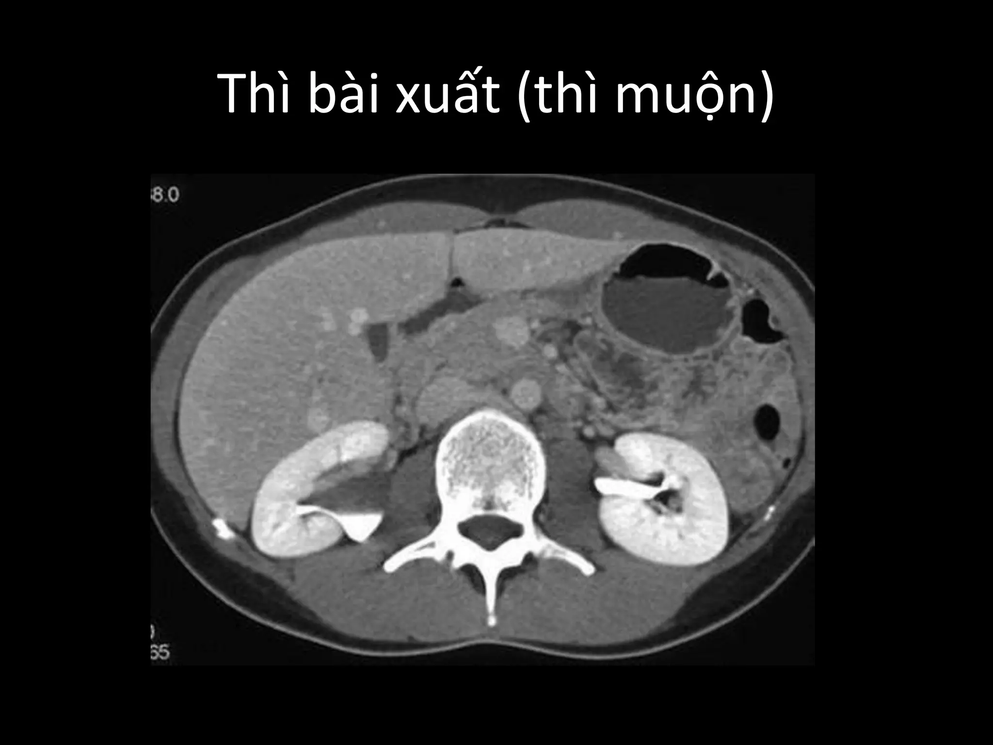CLVT hệ tiết niệu - khoang sau phúc mạc | PPTX