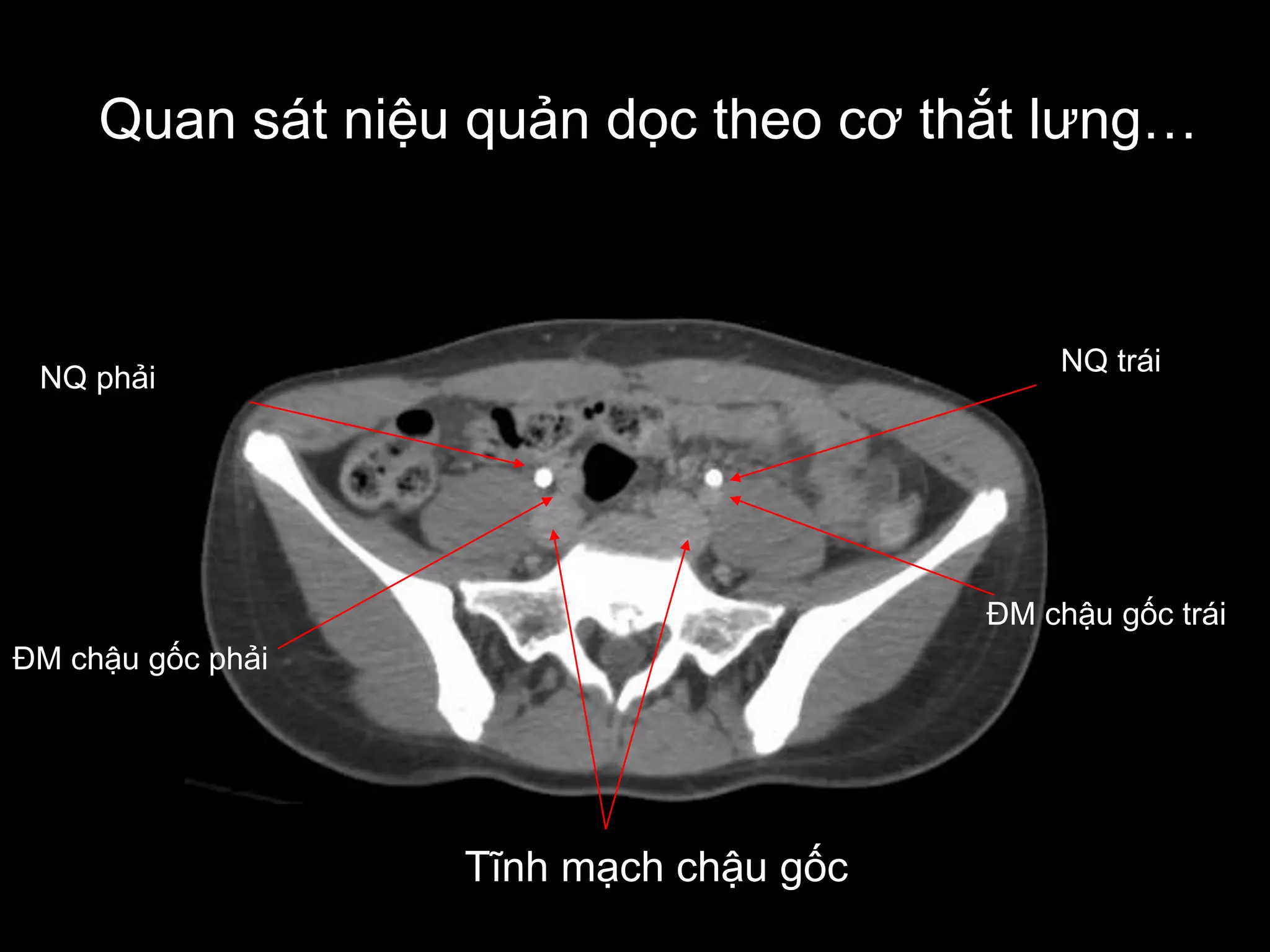 CLVT hệ tiết niệu - khoang sau phúc mạc | PPTX
