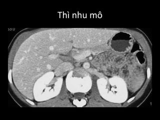 CLVT hệ tiết niệu - khoang sau phúc mạc | PPTX