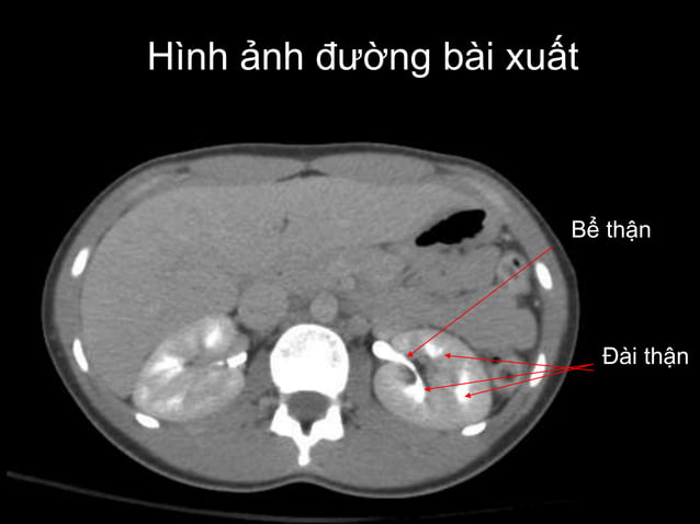 CLVT hệ tiết niệu - khoang sau phúc mạc | PPTX