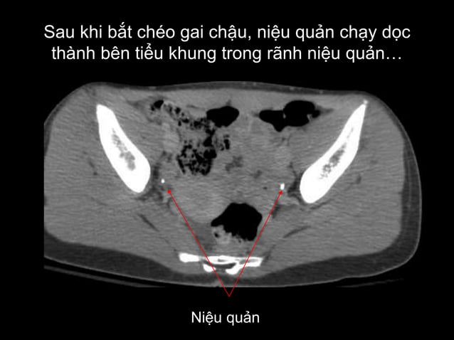 CLVT hệ tiết niệu - khoang sau phúc mạc | PPTX