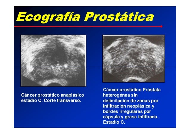 22. ecografia prostatica
