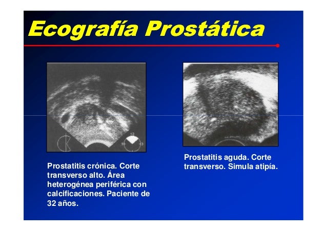 22. ecografia prostatica