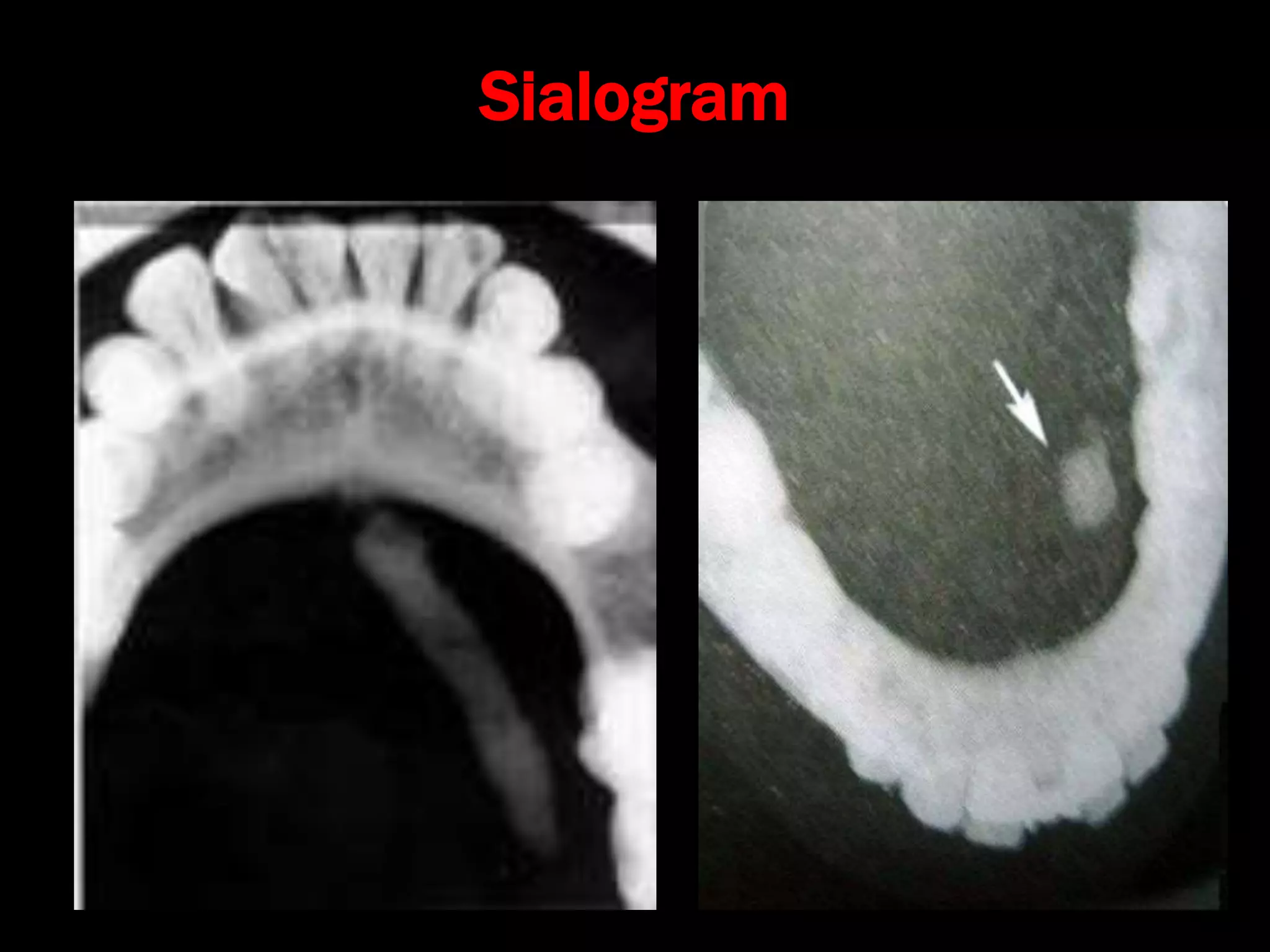 Diseases of salivary glands | PPT