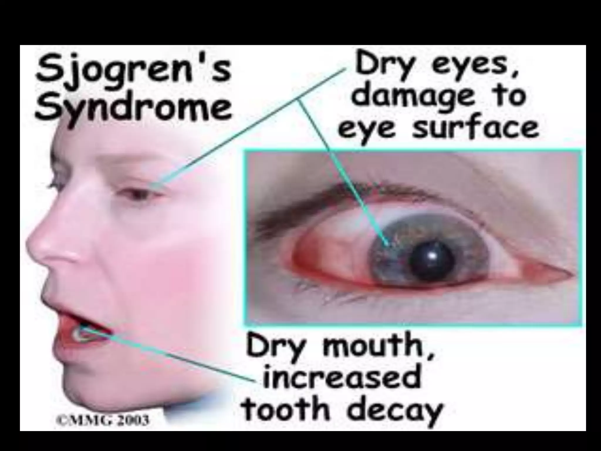 Diseases of salivary glands | PPT